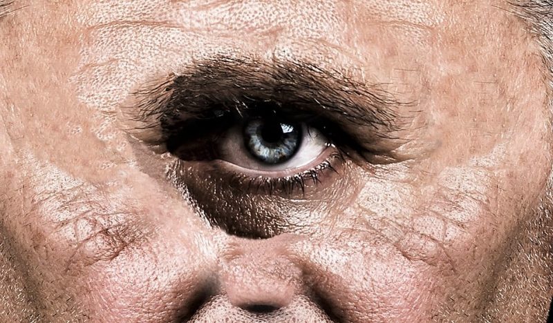 Mild Holoprosencephaly